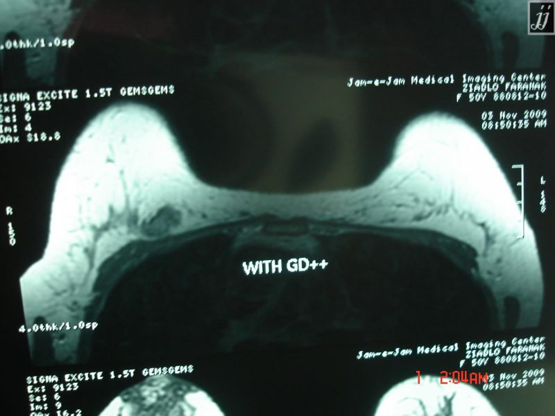 Breast – right breast basal cyst - Radioogle