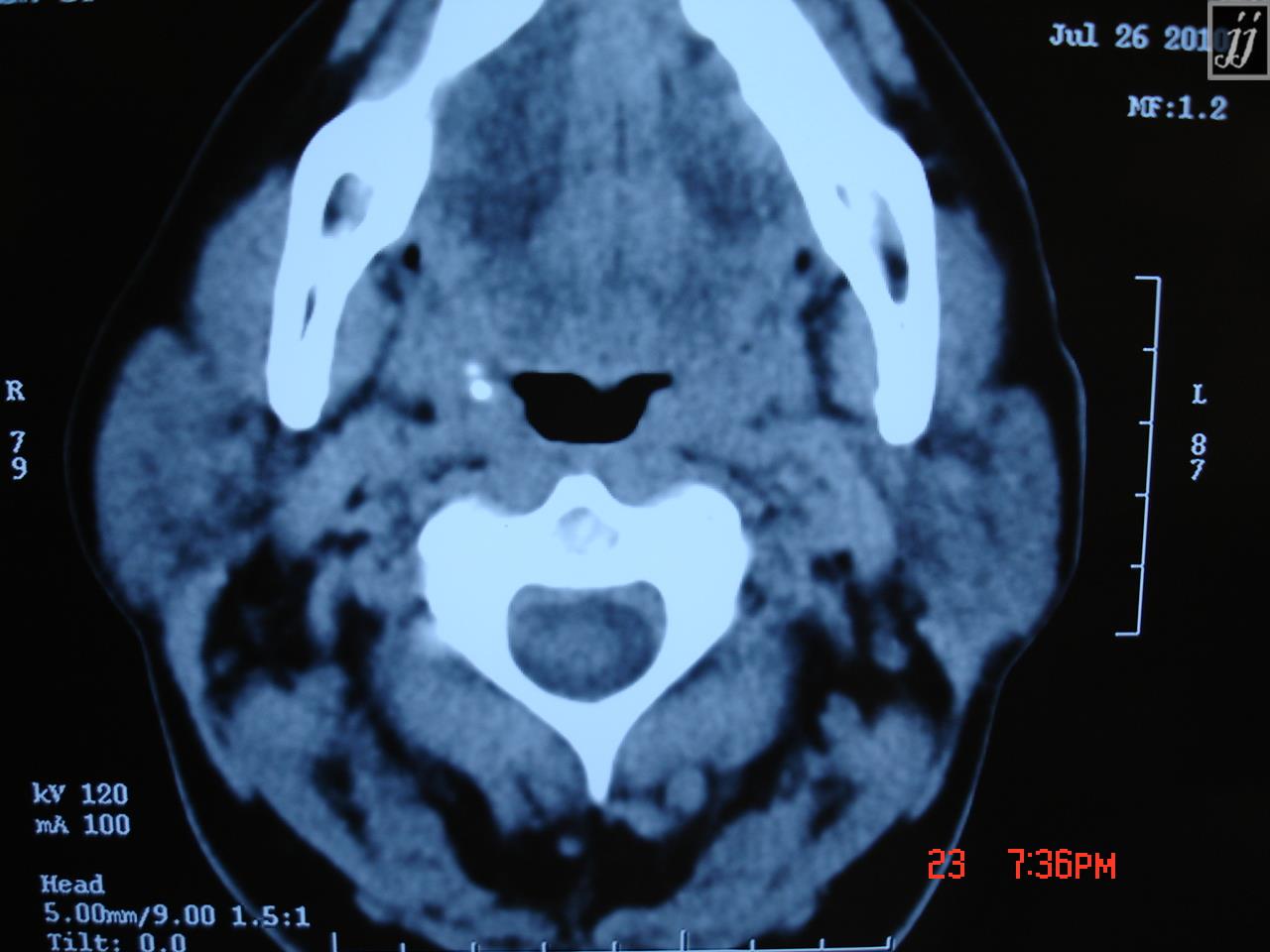 ENT – Parotid Anatomy - Radioogle