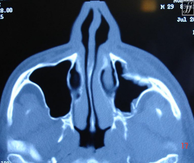 Radioogle | ENT – left maxillary sinus anterior wall fracture