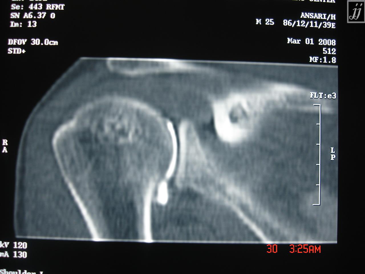 MSK – CT-Arthrography of the shoulder joint (2) - Radioogle