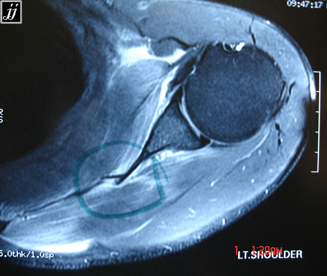 MSK – Supraspinatus and infraspinatus and muscular rupture, with ...