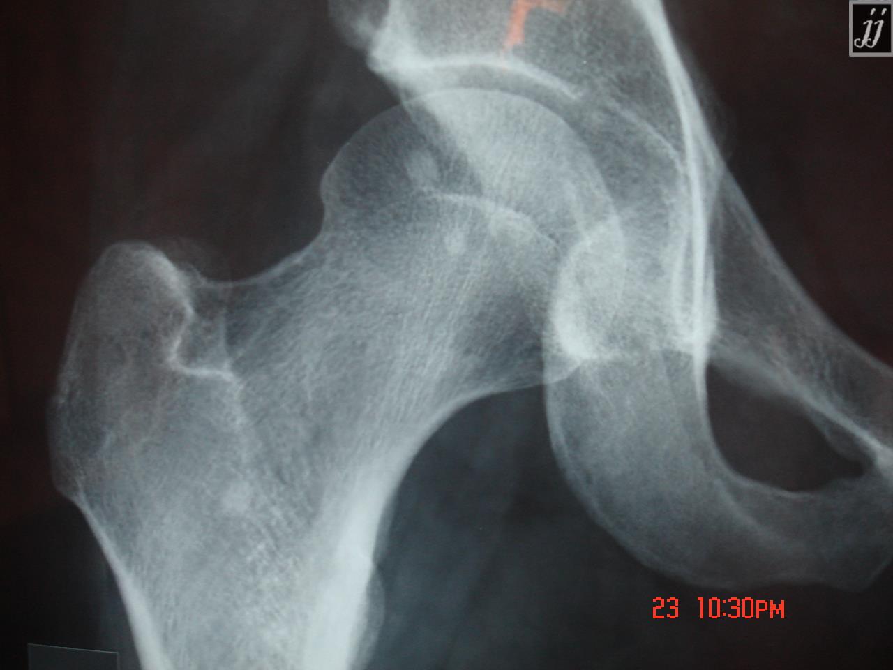 MSK – femoral head bone island - Radioogle