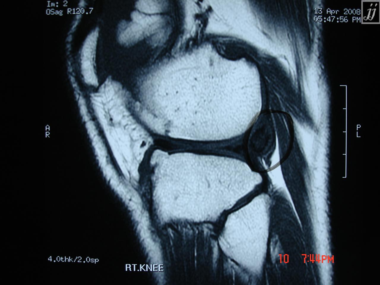MSK – meniscal ganglion cyst (3) - Radioogle