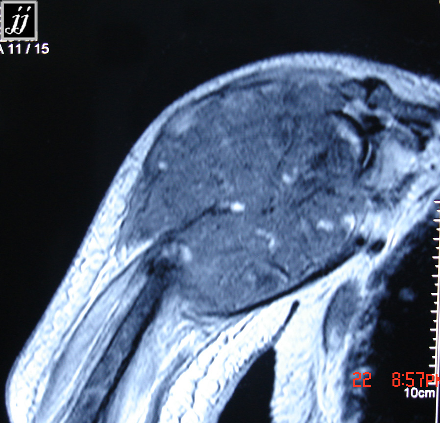 MSK – pathologic fracture of humerus, proximal humerus tumor, coronal ...