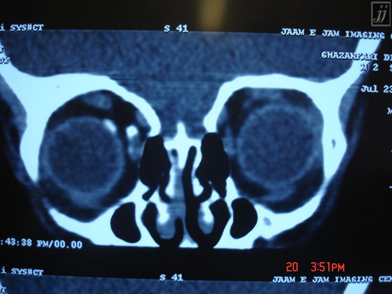 brain-right-middle-cranial-fossa-arachnoid-cyst-and-lipoma-and-orbital ...