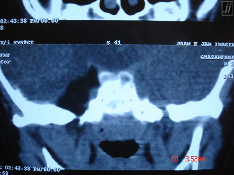 brain-right-middle-cranial-fossa-arachnoid-cyst-and-lipoma-and-orbital ...