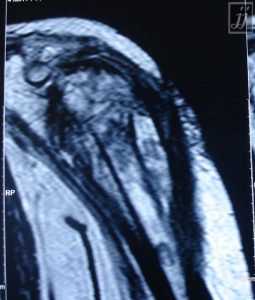 msk-proximal-humerus-osteosarcoma-4 - Radioogle