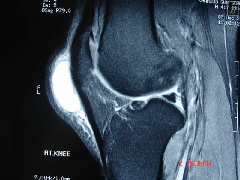 msk-pre-patellar-cellulitis-and-cyst-formation-2 - Radioogle