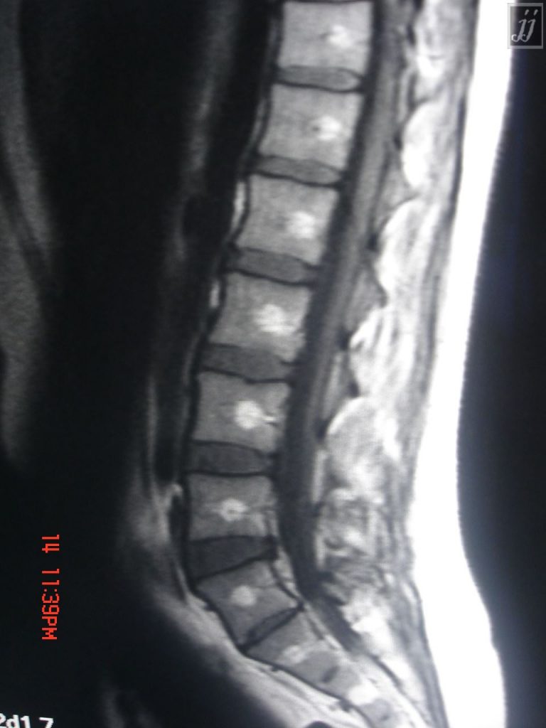 Spine – normal variant basi vertebral vein plexus (2) – Radioogle