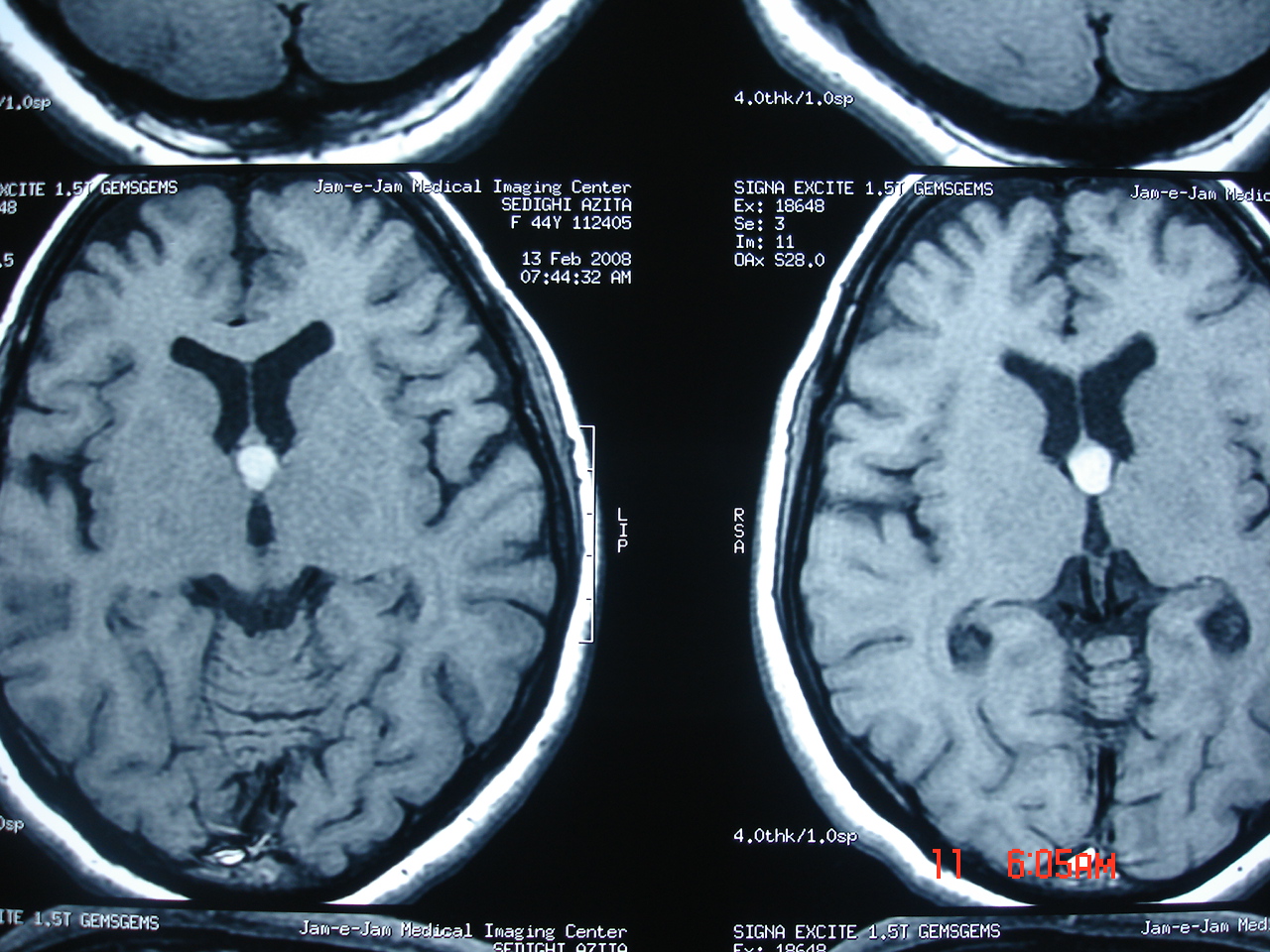 Brain- 3rd ventricular colloid cyst (4) - Radioogle