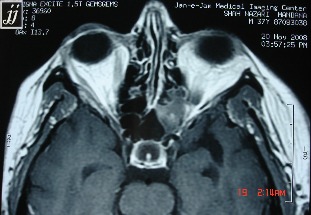 What Is A Retention Cyst In The Sphenoid Sinus - Infoupdate.org