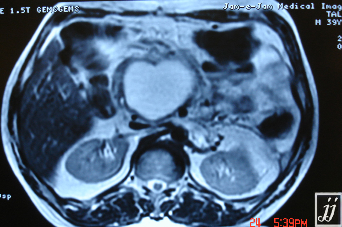 Abdomen- MRCP, pseudo cyst of pancreas (1) - Radioogle