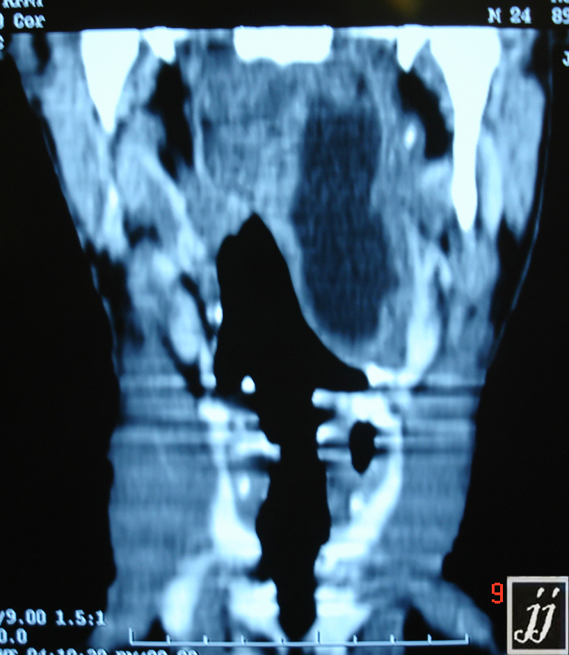 ENT- coronal reaction of pharyngeal abscess (1) - Radioogle