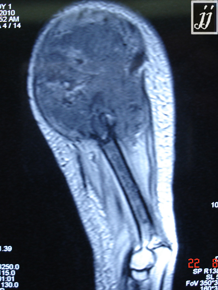 MSK- pathologic fracture of humerus, proximal humerus tumor, sagittal ...