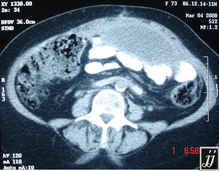 Abdomen- Abdominal wall abscess (5) - Radioogle
