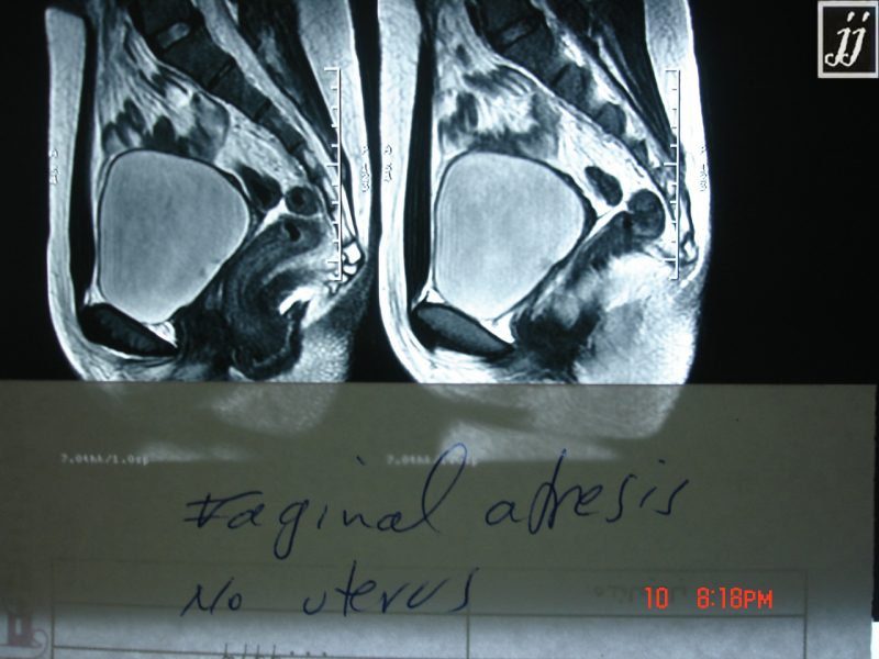 Abdomen- Vaginal Atresis, No uterus, Right Ovarian cyst (1) - Radioogle