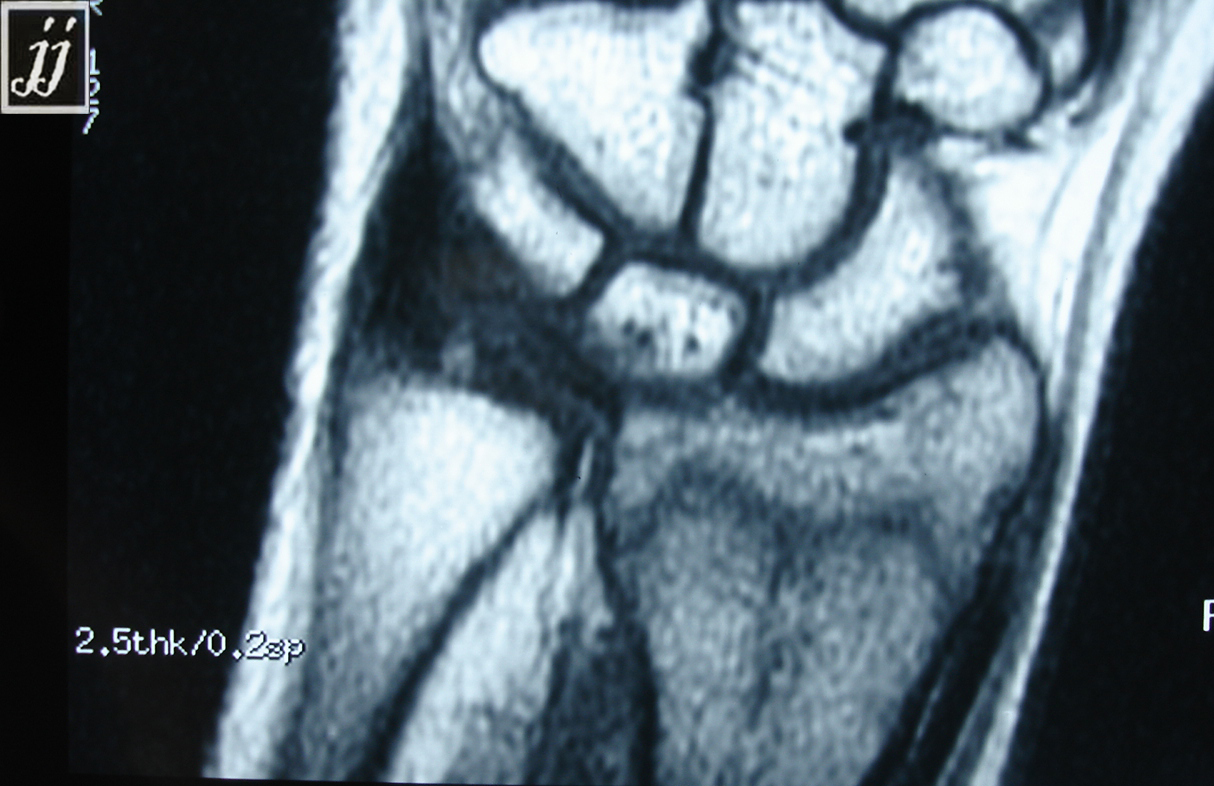 MSK- distal radius fracture (4) - Radioogle