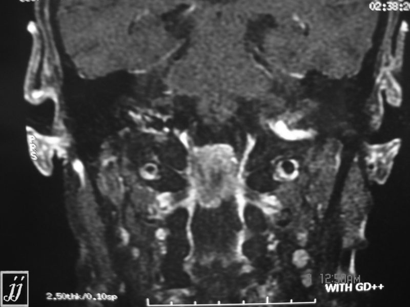 Brain- Intradural extramedullary calcified meningioma of foramen magnum ...