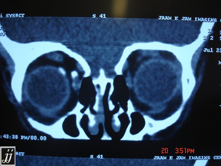 Brain- right middle cranial fossa arachnoid cyst and lipoma and orbital ...