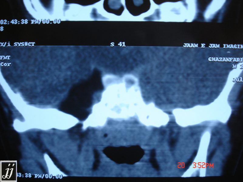 Brain- right middle cranial fossa arachnoid cyst and lipoma and orbital ...