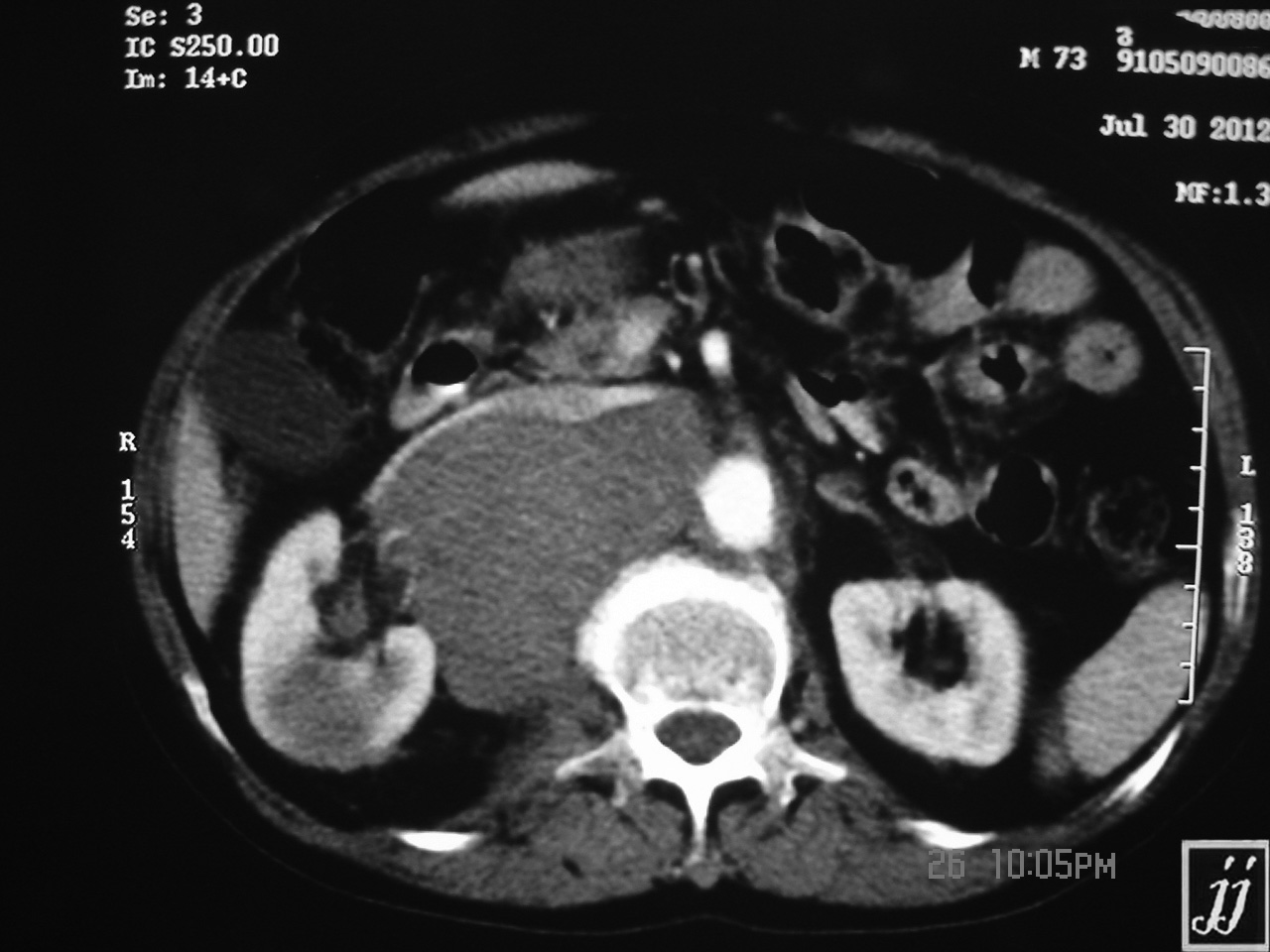 Chest- intra cardiac and retroperitoneal tumor (8) - Radioogle