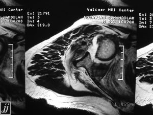 MSK- Anterior dislocation of shoulder joint - Radioogle