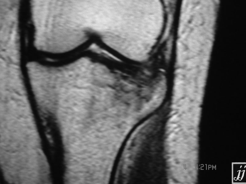 MSK- Tibia fracture, Intra articular hemorrhage and fat fluid level (5 ...