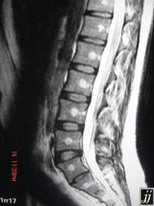 Spine- normal variant basi vertebral vein plexus (1) - Radioogle