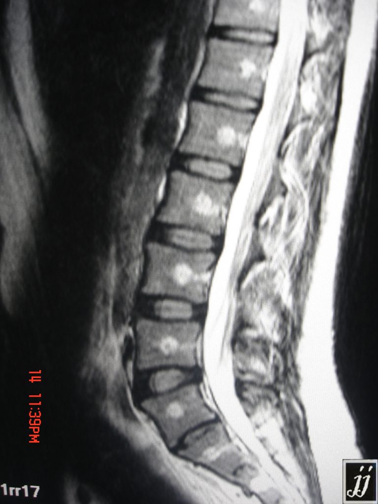 Spine- normal variant basi vertebral vein plexus (1) - Radioogle