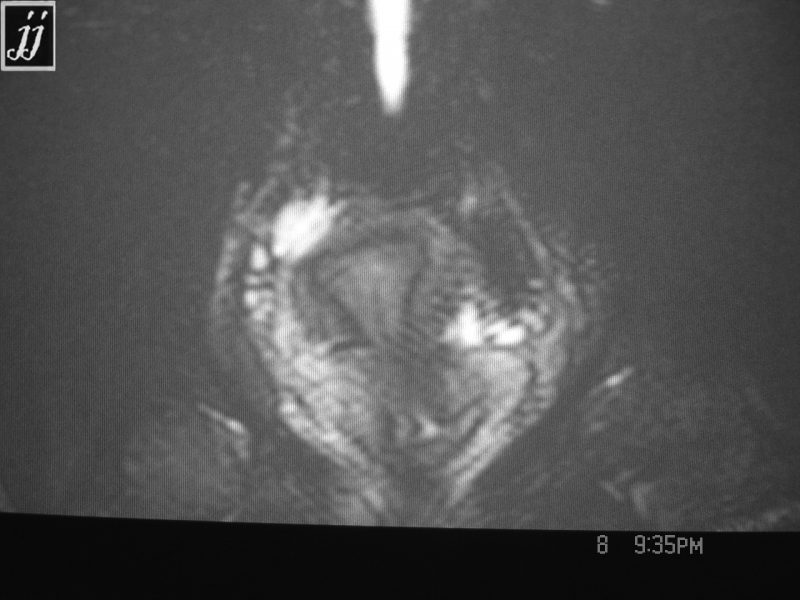 Abdomen- retroverted uterus (3) - Radioogle
