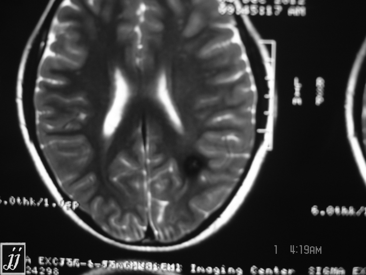 Brain- left posterior parietal cavernoma (6) - Radioogle
