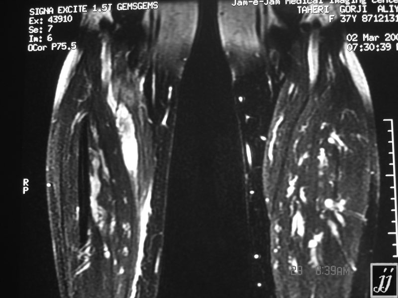 MSK- posterior tibia muscle hemorrhage and partial rupturing (6 ...