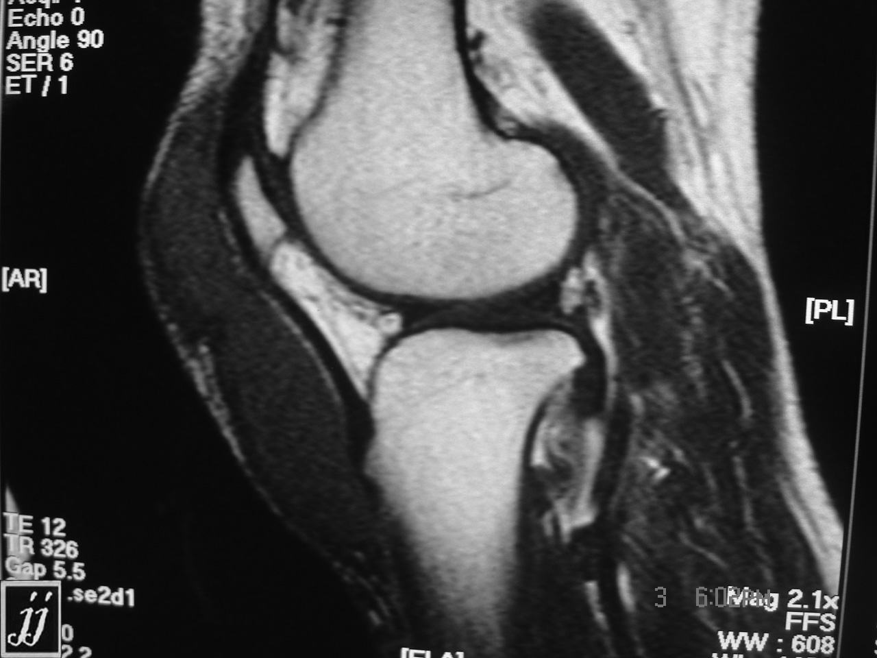 MSK- pre patellar and pre tibia bursitis cellulitis or abscess (7 ...
