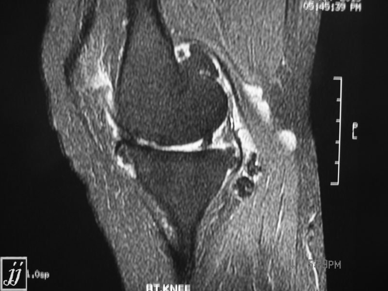 MSK- pre patellar and pre tibia bursitis cellulitis or abscess (8 ...