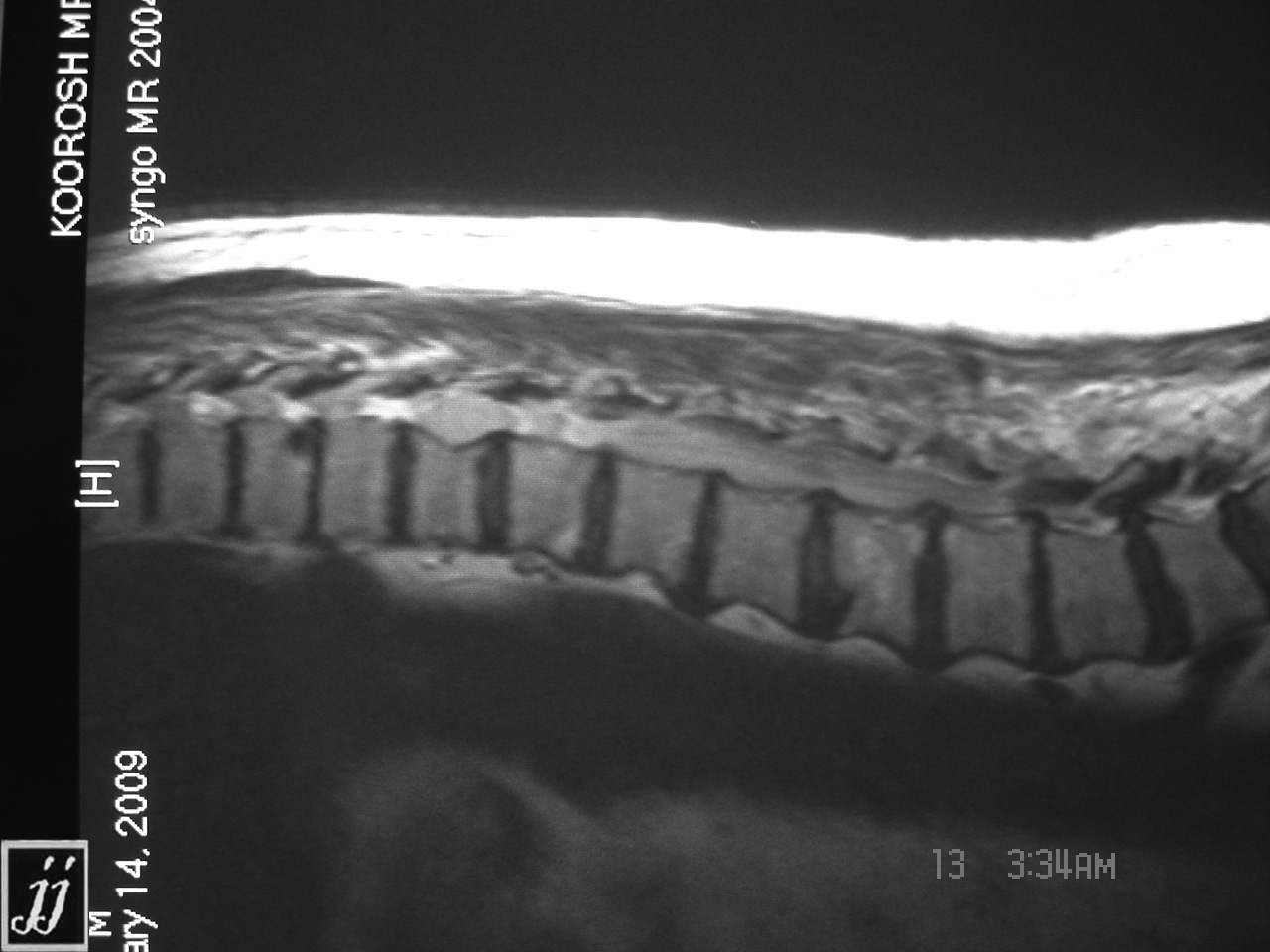 Spine- hydatid cyst of dorsal spine (3) - Radioogle