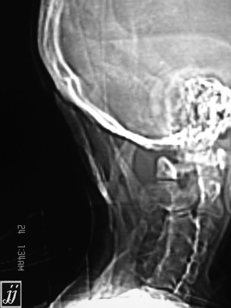 Spine- posterior neck ligament calcification (1) - Radioogle