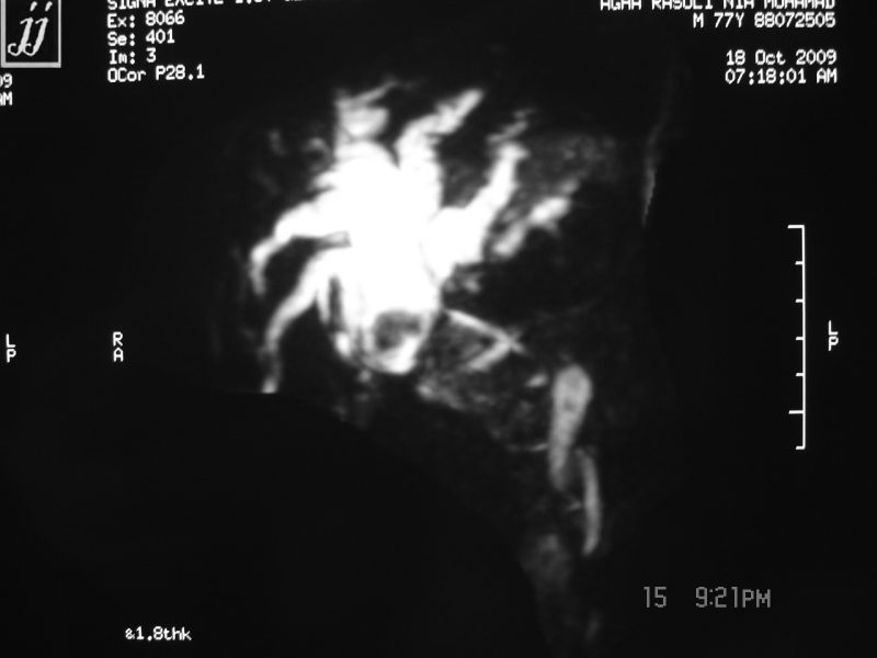Abdomen- MRCP, wide intra hepatic bile ducts and kidney hydronephrosis ...