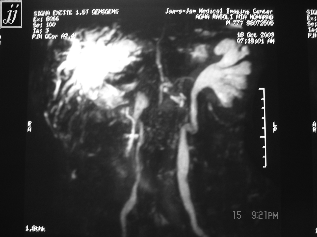 Abdomen- MRCP, wide intra hepatic bile ducts and kidney hydronephrosis ...
