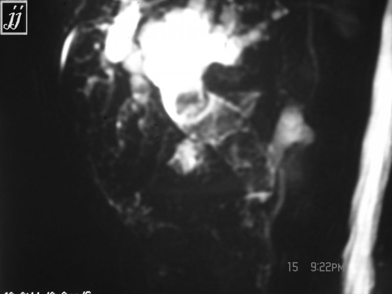 Abdomen- MRCP, wide intra hepatic bile ducts and kidney hydronephrosis ...
