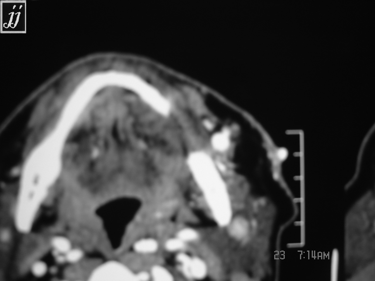 ENT- AVF between left carotid and jugular system, rare case (11 ...