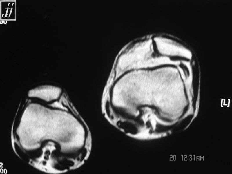 MSK- Posterior horn of medial menisci is torn and fluid and bone ...