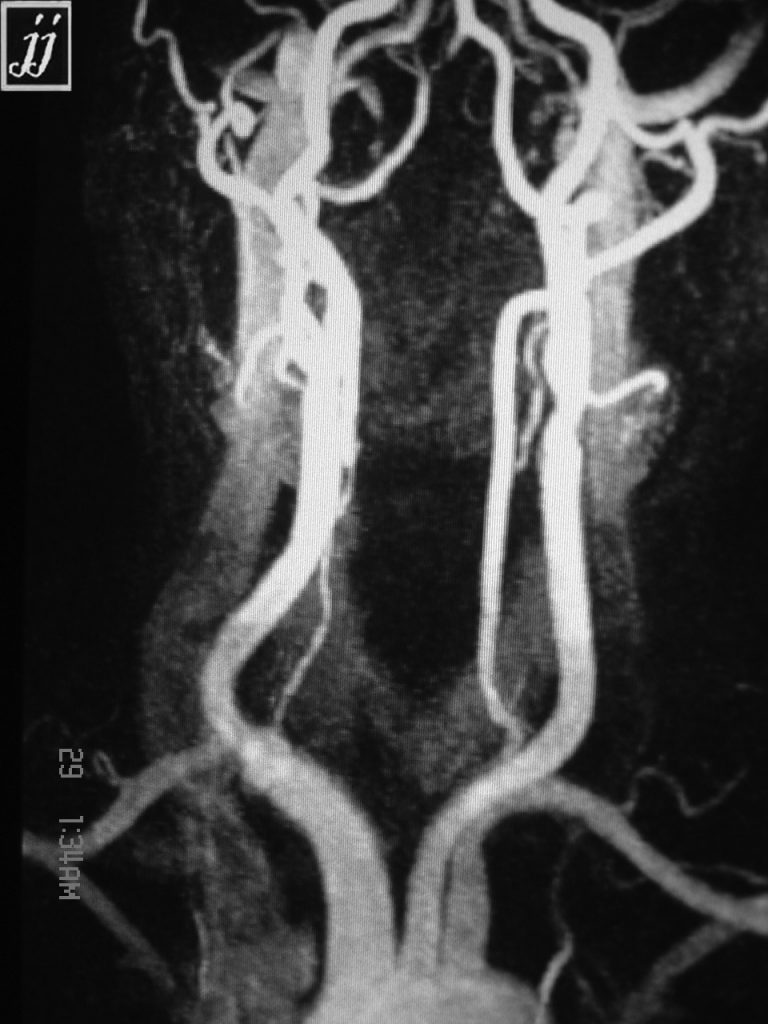 Vascular- right vertebral artery original stenosis (2) - Radioogle