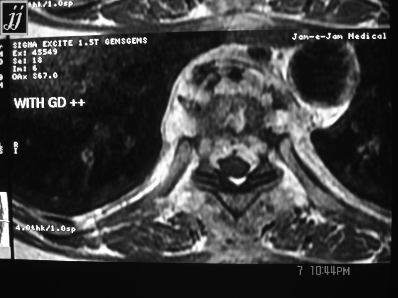 Spine- Dorsal vertebral body compression fracture and complications (4 ...