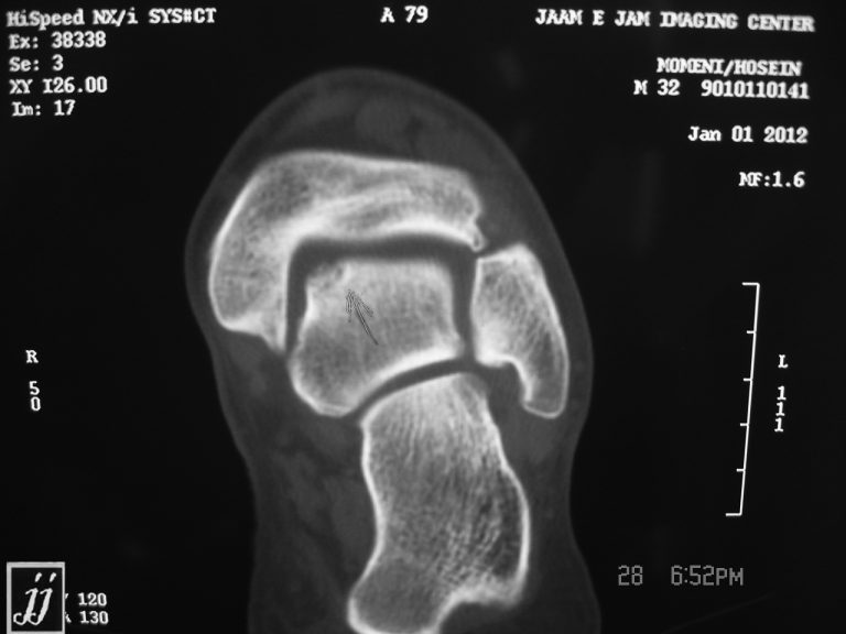 MSK- subchondral bone defect of talus and posterior tibia talar loose ...