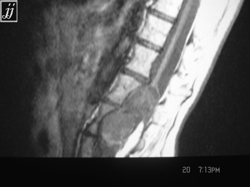 Spine- Lumbar lipoma and tumor and V body deformities (Neurofibroma ...