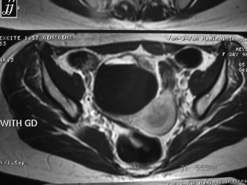Abdomen- large cystic lesion containing fat fluid level, teratodermoid ...