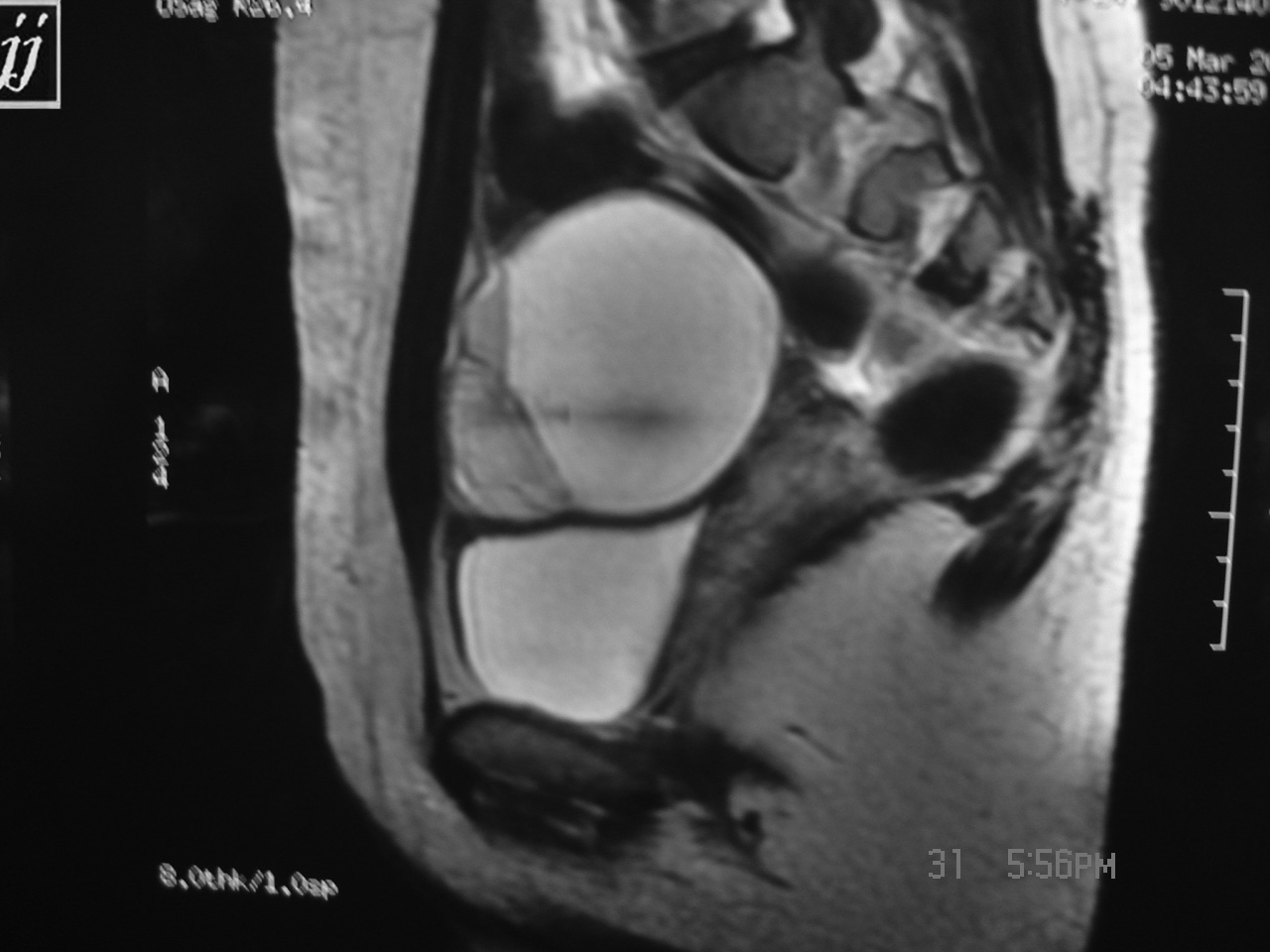 Abdomen- large cystic lesion containing fat fluid level, teratodermoid ...