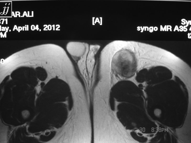 Abdomen- left inguinal mass (1) - Radioogle