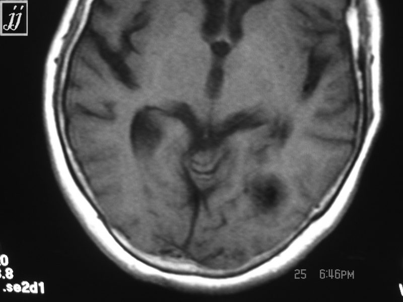 Brain- calcified left posterior parietal or visual cortex lesion (5 ...