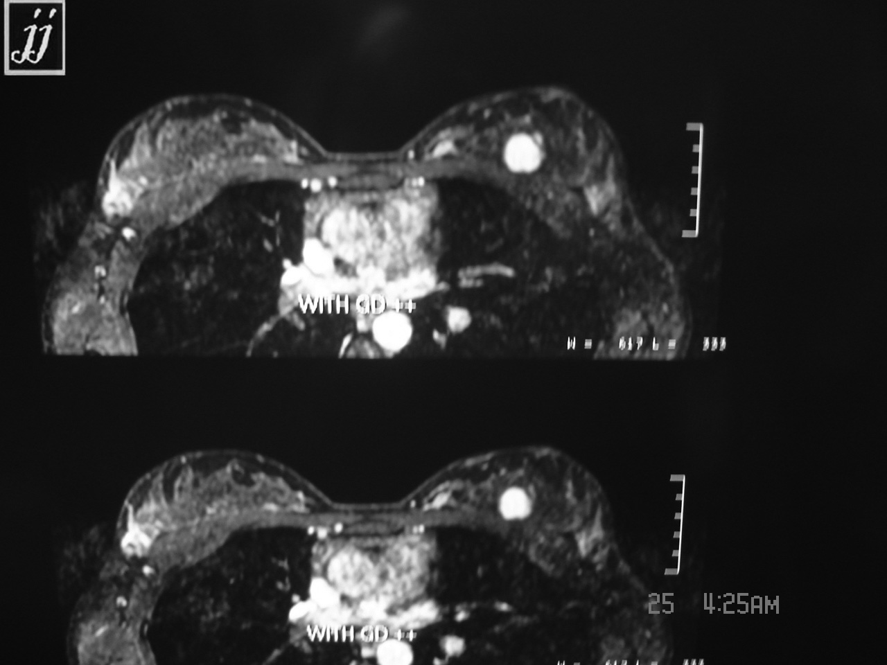 Breast- right breast cyst and left breast mass (5) - Radioogle